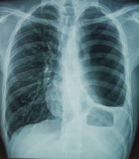 Postoperative One Month Follow Up Cxr Showing Unresolved Pneumothorax Download Scientific