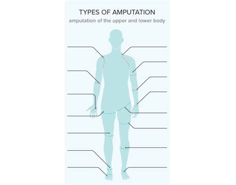 Clinical Conditions 2 Types Of Amputation Quiz