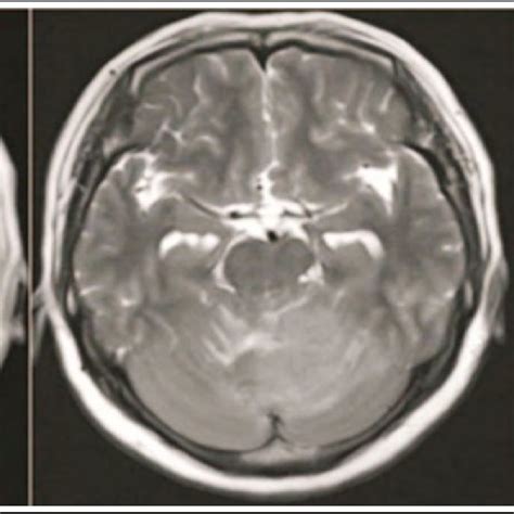 Mri Image Of Diffuse Large B Cell Lymphoma Download Scientific Diagram