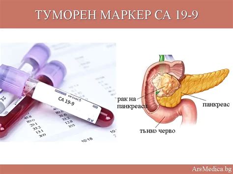 Високо СУЕ причини Arsmedica Bg