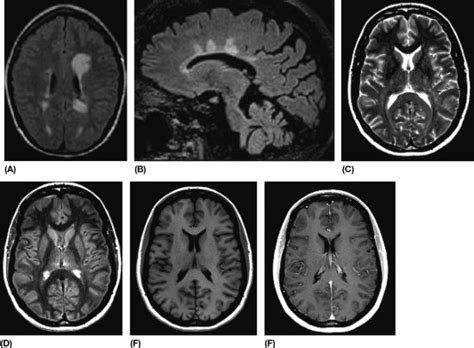 Magnetic Resonance Imaging In Multiple Sclerosis Musculoskeletal Key