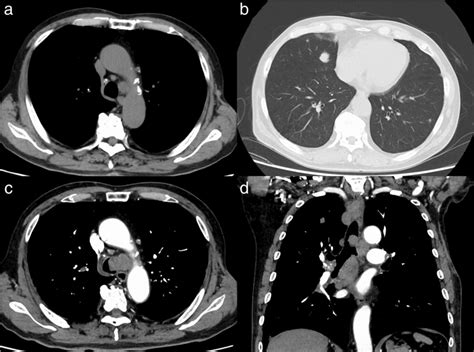Chest Computed Tomography Ct On The Initial Visit And Admission A