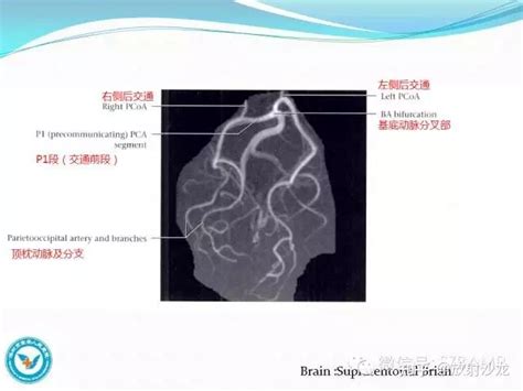椎 基底动脉系统ct，mr及dsa影像解剖 知乎
