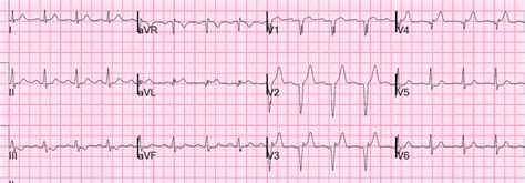 Cardiac Aneurysm Ecg