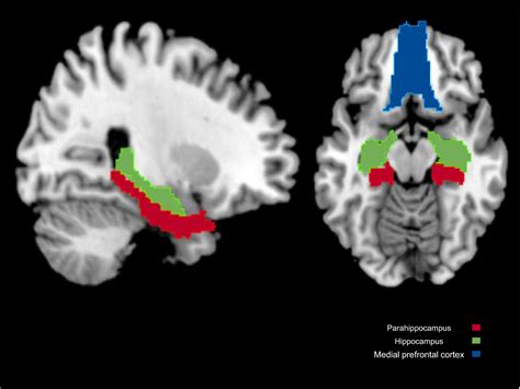 Medial Prefrontal Cortex