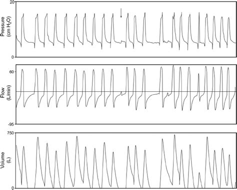 Missedineffective Triggering Arrow Is Characterized By A Decrease In