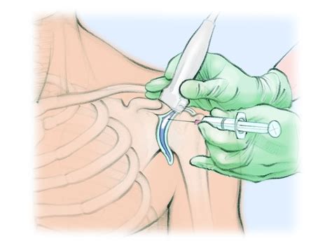 Arthrogram — The Interventional Initiative