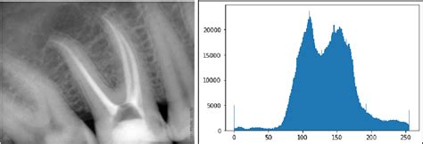 Figure 1 From Improving Radiographic Image Contrast Using Multi Layers Of Histogram Equalization