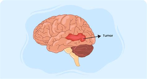 Brain Tumors And Metastasis Course Medtigo Courses