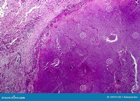 Caseous Necrosis In Tb