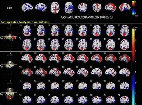 Statistical Maps In Patient 1 Analyzed By Three‐dimensional Download Scientific Diagram