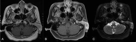Polyp Of Middle Ear Semantic Scholar