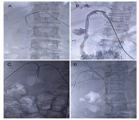 A Single System Biliary Stenting For Type 3a Cholangiocarcinoma From