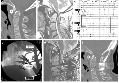 Case 5 The Sagittal Computed Tomography Ct Scan Revealed Dystopic Os