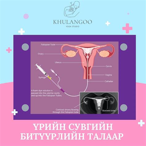 Үрийн сувгийн битүүрэл гэж юу вэ Үрийн суваг буюу Фаллопийн хоолой