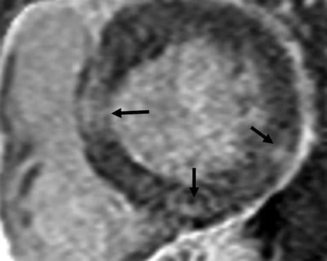Radiological Detection Of Cardiac Amyloid Mri With Pathological Correlation Applied Radiology