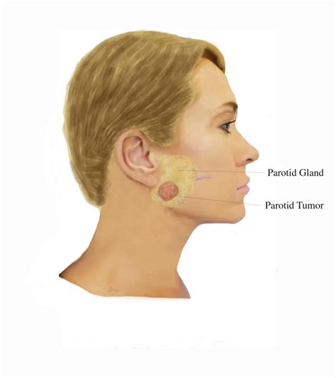 What Is The Parotid Why Do I Need A Parotidectomy American Head And Neck Society