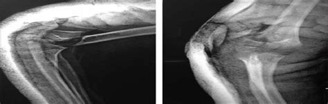 Percutaneous Lateral Kirschner Wire Fixation In Pediatric Su