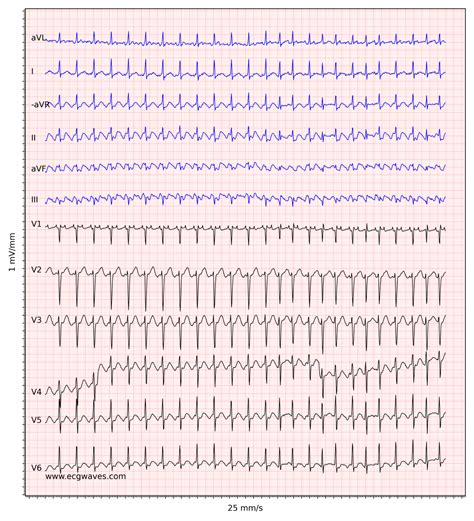 Atrial Flutter Classification Causes Ecg Criteria And Management The Cardiovascular