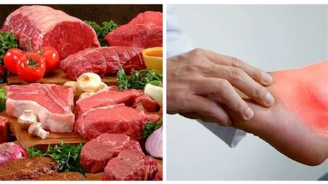¿qué Pasa Si Tengo El ácido úrico Alto 5 Alimentos Que Lo Aumentan Y