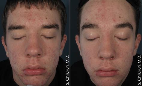 Acne Scar Treatment In Houston Refresh Dermatology