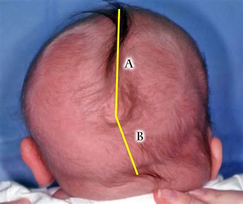 Lambdoid Synostosis Facts And Photos Craniosynostosis