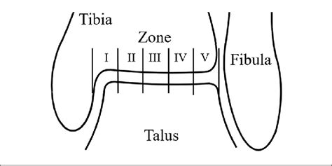 Five Zones Of Anterior Margin Of The Tibia Zone 1 Medial Shoulder Download Scientific Five Zones Of Anterior Margin Of The Tibia Zone 1 Medial Shoulder Download Scientific