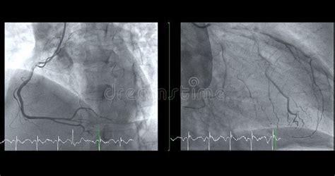 Cardiac Catheterization On Rca And Lad Can Help Doctor Diagnose And
