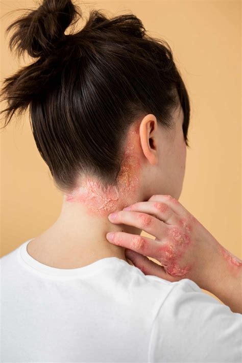Difference Between Scalp Psoriasis And Dandruff