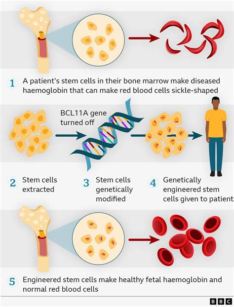 Nhs To Offer Groundbreaking Sickle Cell Gene Therapy Bbc News