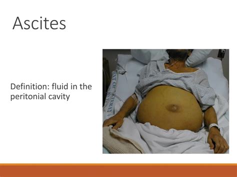 Ppt Complications Of Liver Cirrhosis Portal Hypertension Management