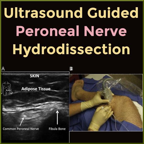 Ultrasound Guided Common Peroneal Nerve Hydrodissection Sports