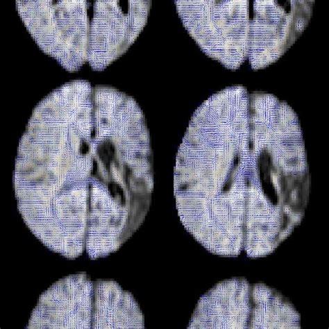 Projection Of The High Activated Region Of The Visual Cortex Fmri