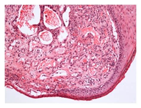 Polypoid Granuloma Pyogenicum Like Lesion With Ectatic Lobular
