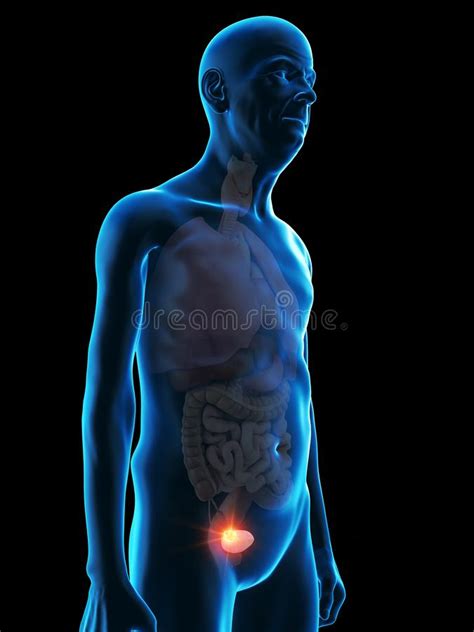 Tumor De Vejiga Urinaria Del Hombre Viejo Stock de ilustración ...