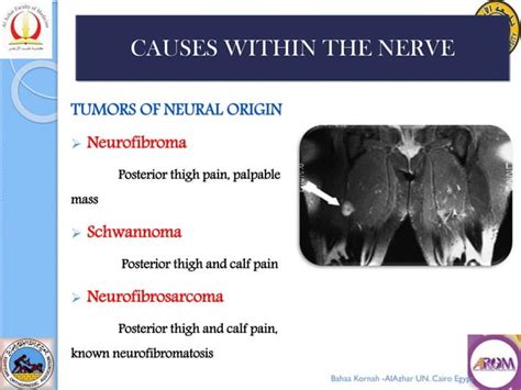 Extra Spinal Causes Of Sciatica And A Causes Algorithm Ppt