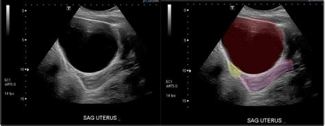 Urine Trouble Tricky Bladder Mimics Em Ultrasound Section