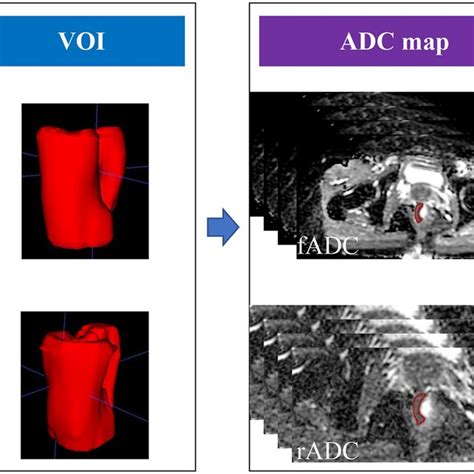 Process Of The Tumor Segmentation And Feature Extraction The Volume Of