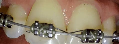 My Dentist Said They Dont Fix Deep Bites With Bite Plates Or Bite Turbos But Instead Elastics