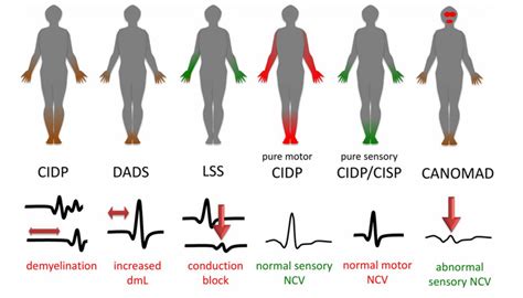 Cidp And Associated Chronic Inflammatory Neuropathies Gain