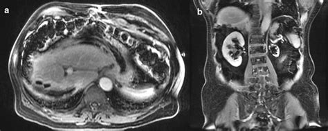 No Recurrent Disease On Mri 1 Month Post Partial Right Hepatectomy A