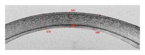 Thickness Of A Dsaek Graft As Measured On An As Oct Image Both Total Download Scientific