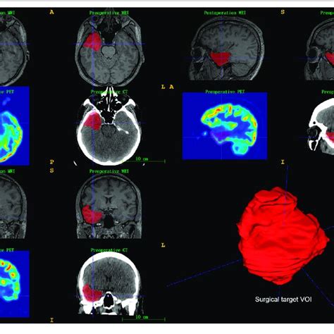 Illustration Of Surgical Target Brain Volume Of Interest Voi