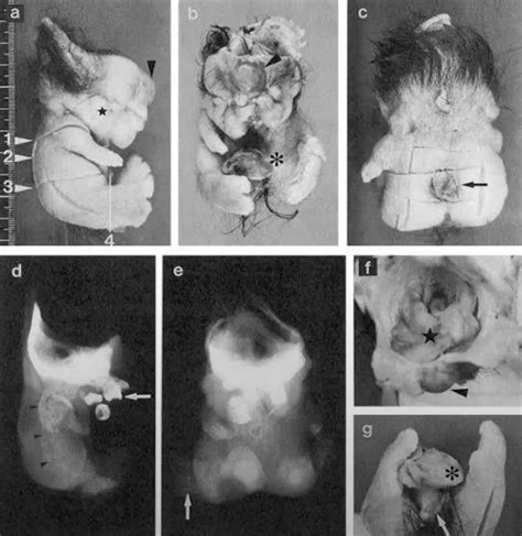 Mature Ovarian Cystic Teratoma With A Highly Differentiated Homunculus Wpd