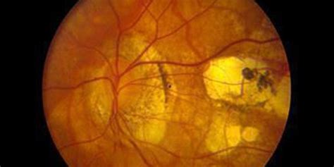 High Degenerative Myopia