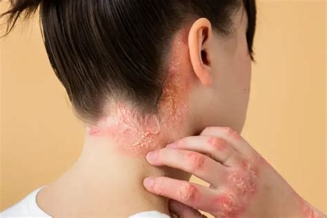 قارچ پوستی چیست و درمان سریع قارچ پوستی اهواز فارما