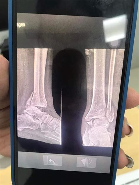 Orif More Info In Comments R Orthopaedicsurgery