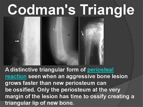 Osteogenic Sarcoma Codmans Triangle Preoperative Neoadjuvant