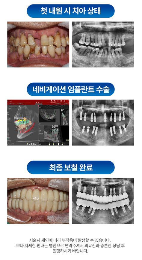 디지털 전체 임플란트 메가탑치과