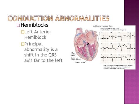 Av Blocks Firstdegree Pr Av Block Interval 0